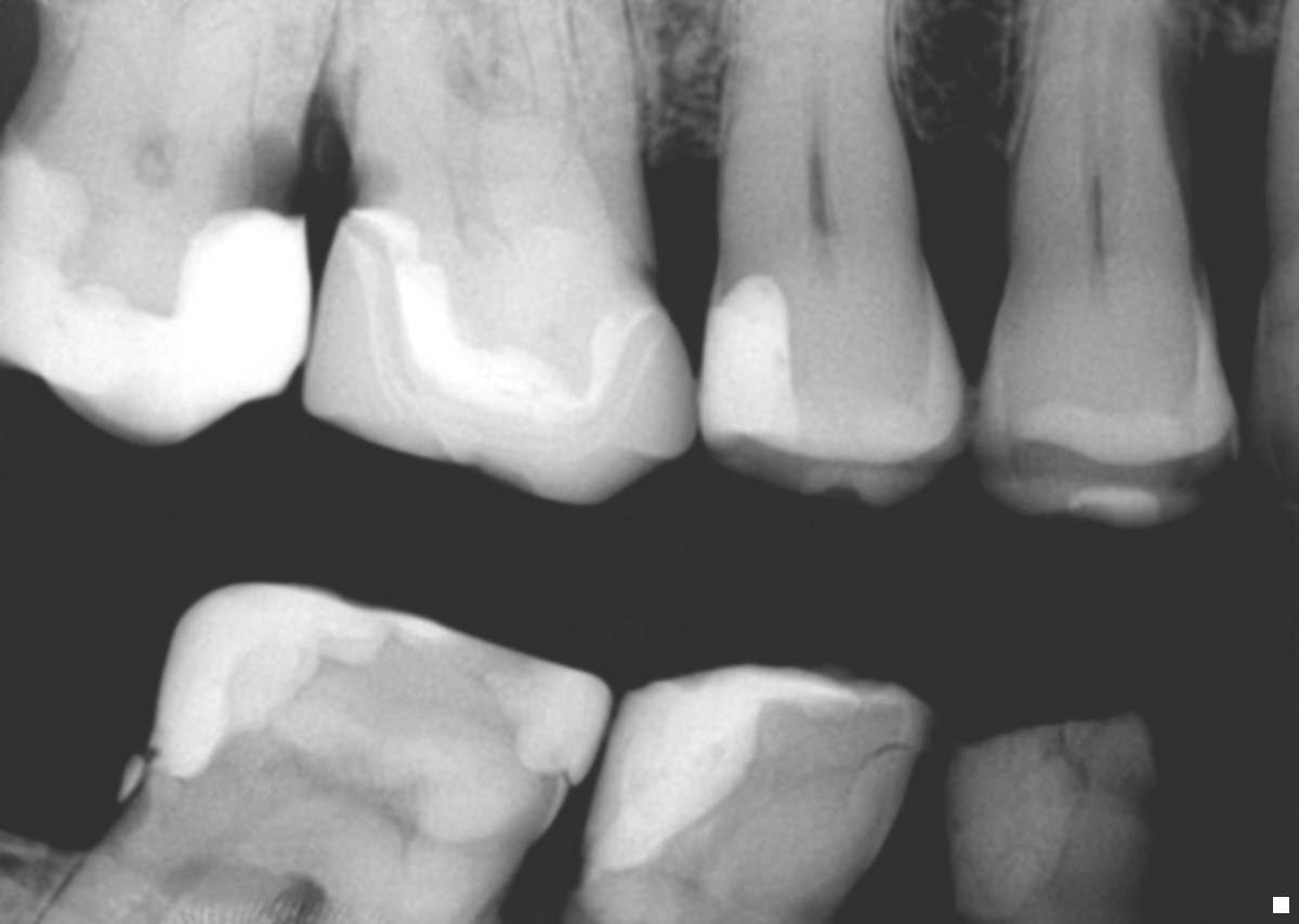 Saving Near Hopeless Teeth Saving Near Hopeless Teeth