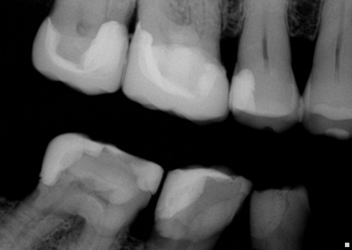 Saving Near Hopeless Teeth Saving Near Hopeless Teeth