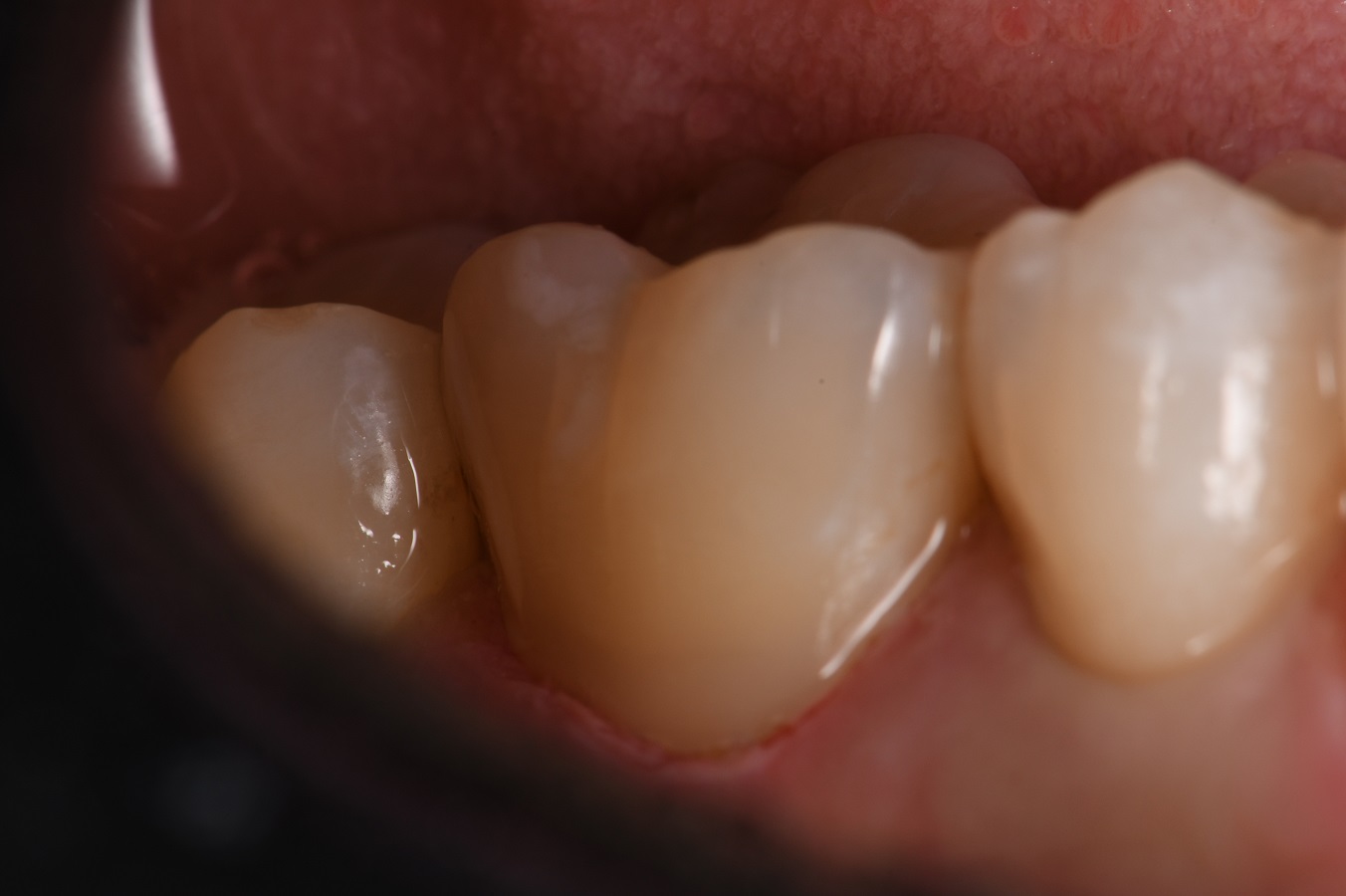 Class V Abrasion Fine Restorations Class V Abrasion Fine Restorations