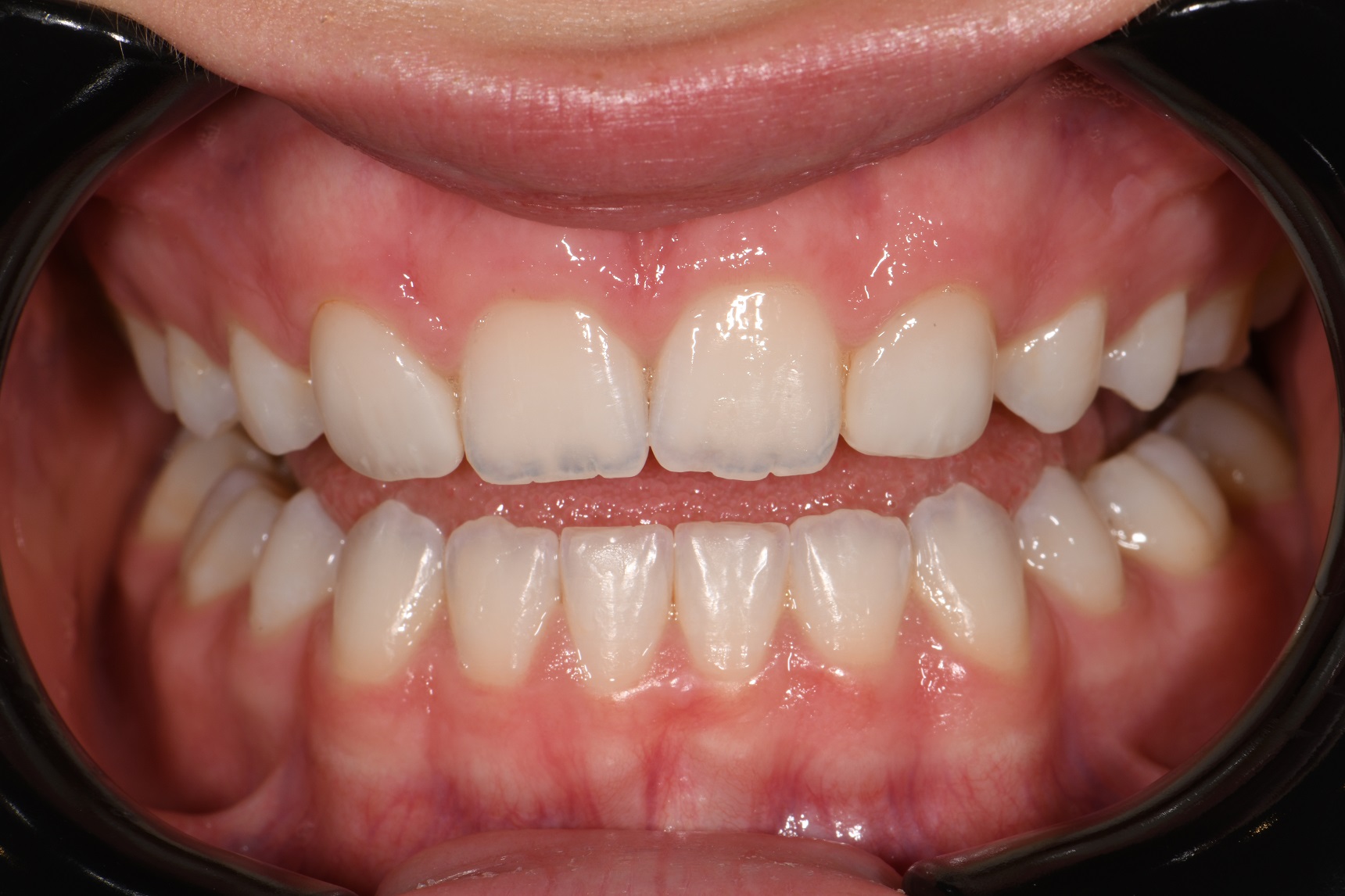 Canine Substitution Composite Restorations