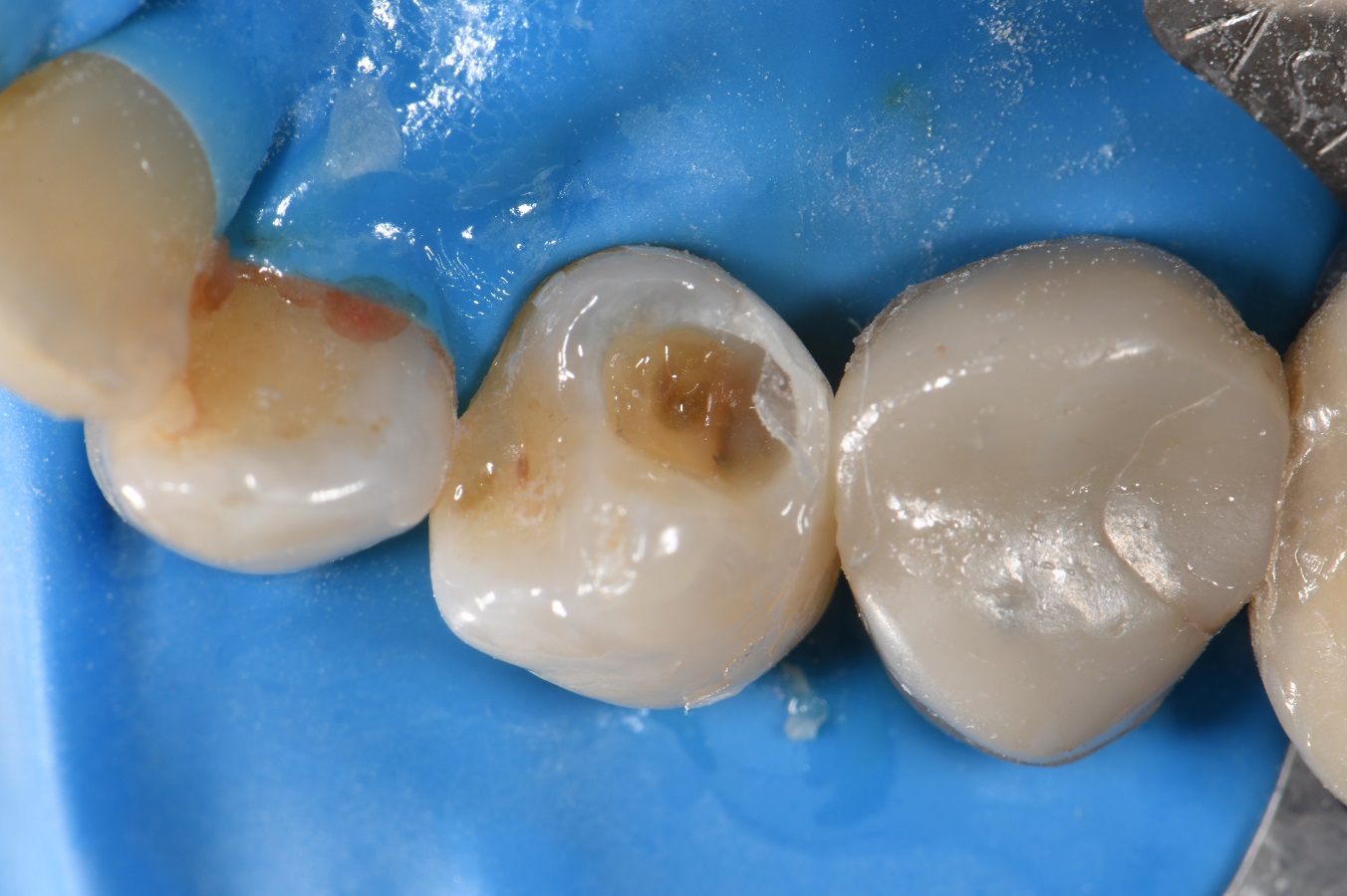Class II Challenge in tooth 28