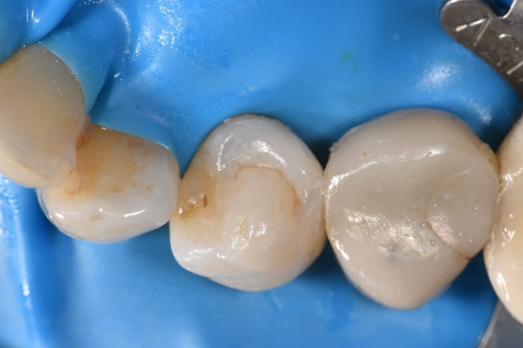Class II Challenge in tooth 28