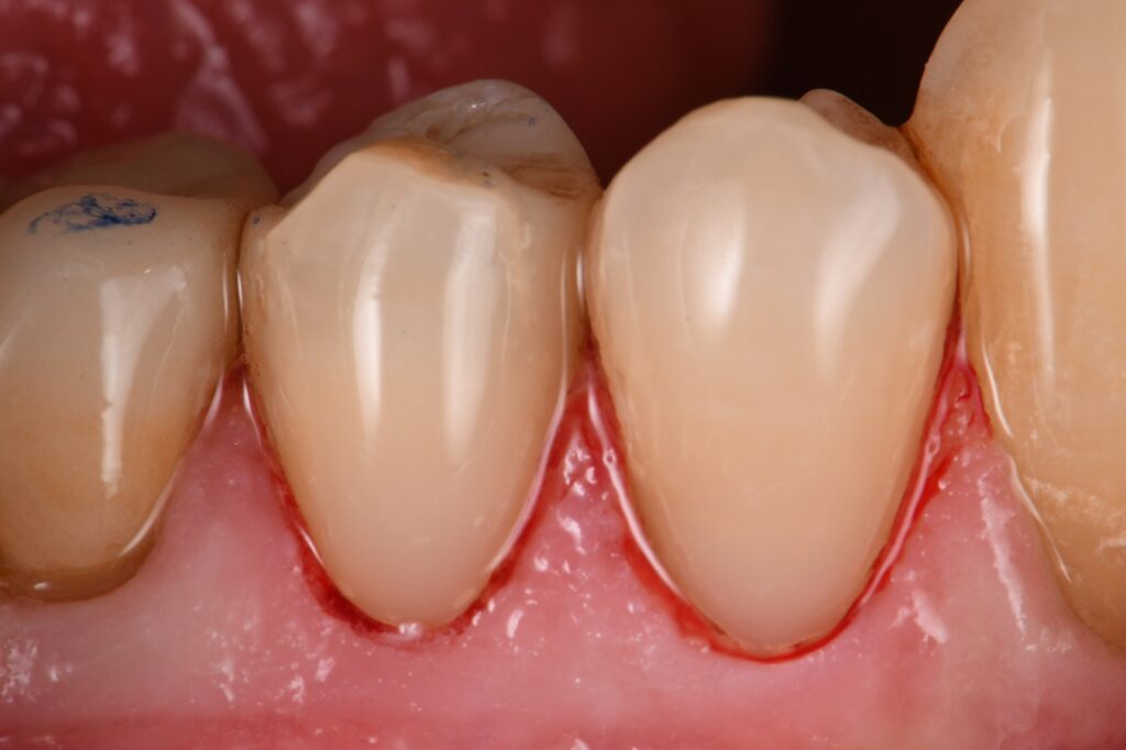 Rebuilding Lost Tooth Structure Rebuilding Lost Tooth Structure