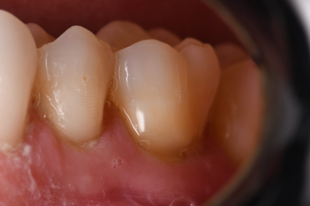 Class 5 composite restorations