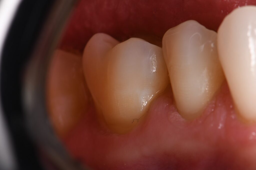 Class 5 composite restorations