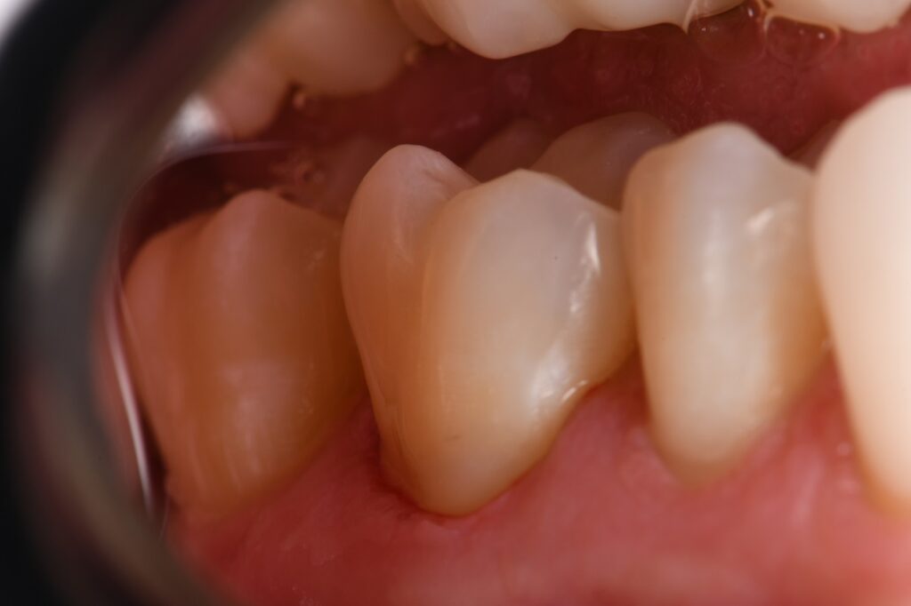 Class 5 composite restorations