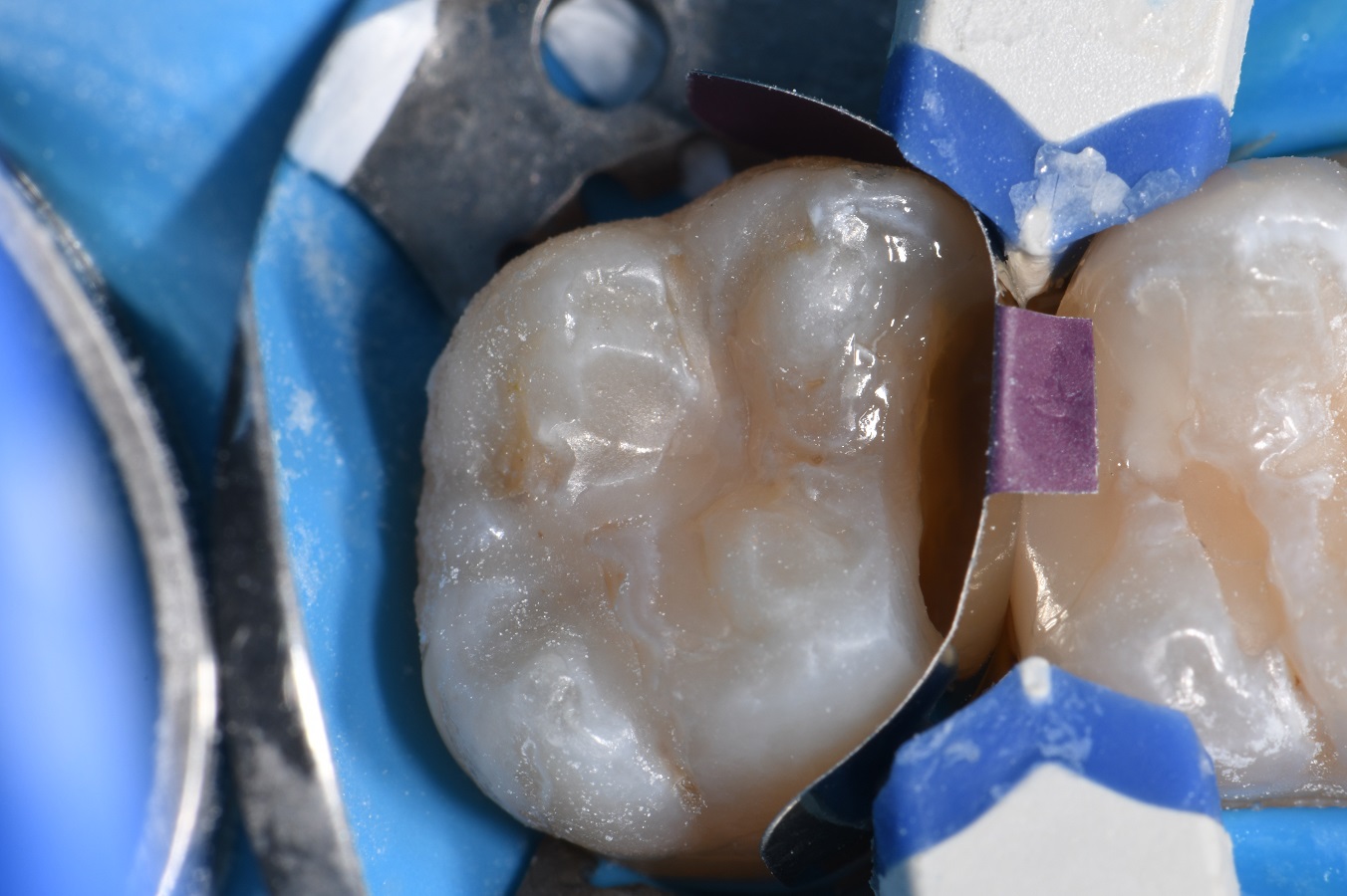 Slot Restorations | Voco Admira Fusion Slot Restorations | Voco Admira ...