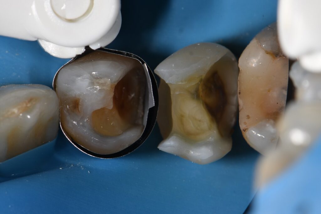 Matrix in Matrix assembly for complex dental fillings Matrix in Matrix ...