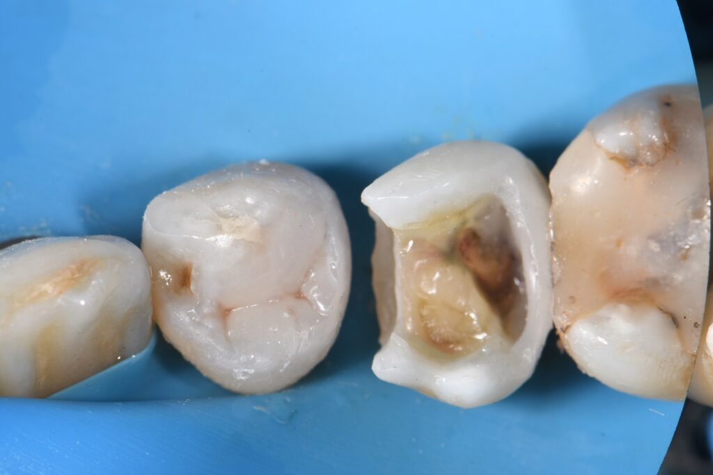 Matrix in Matrix assembly for complex dental fillings Matrix in Matrix ...