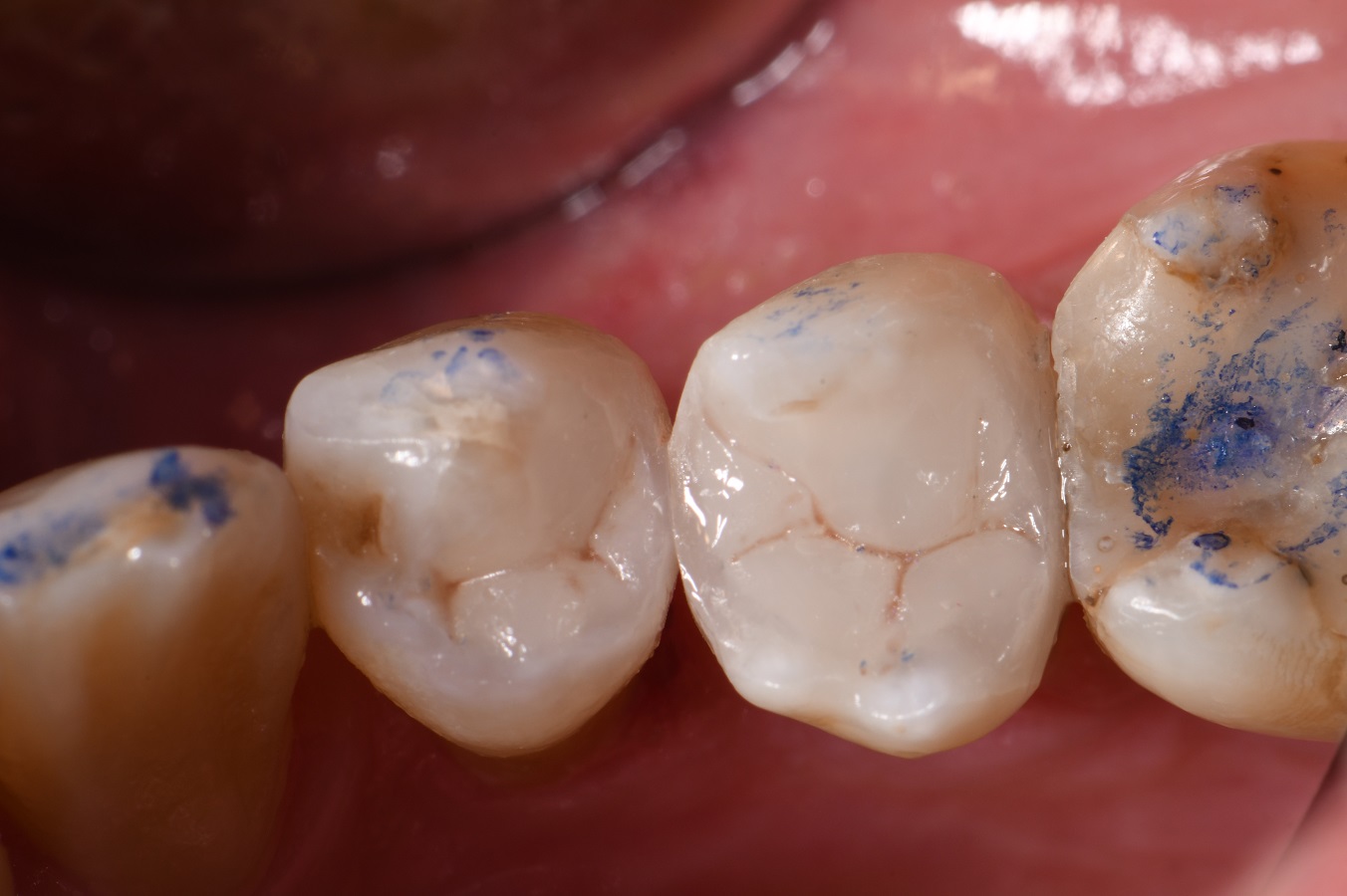 Matrix in Matrix assembly for complex dental fillings Matrix in Matrix ...