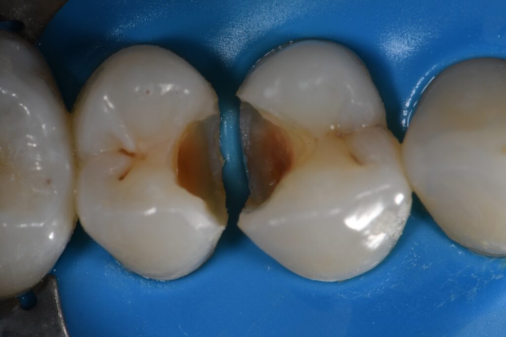 Matrix in Matrix strategy for Class II reconstructions