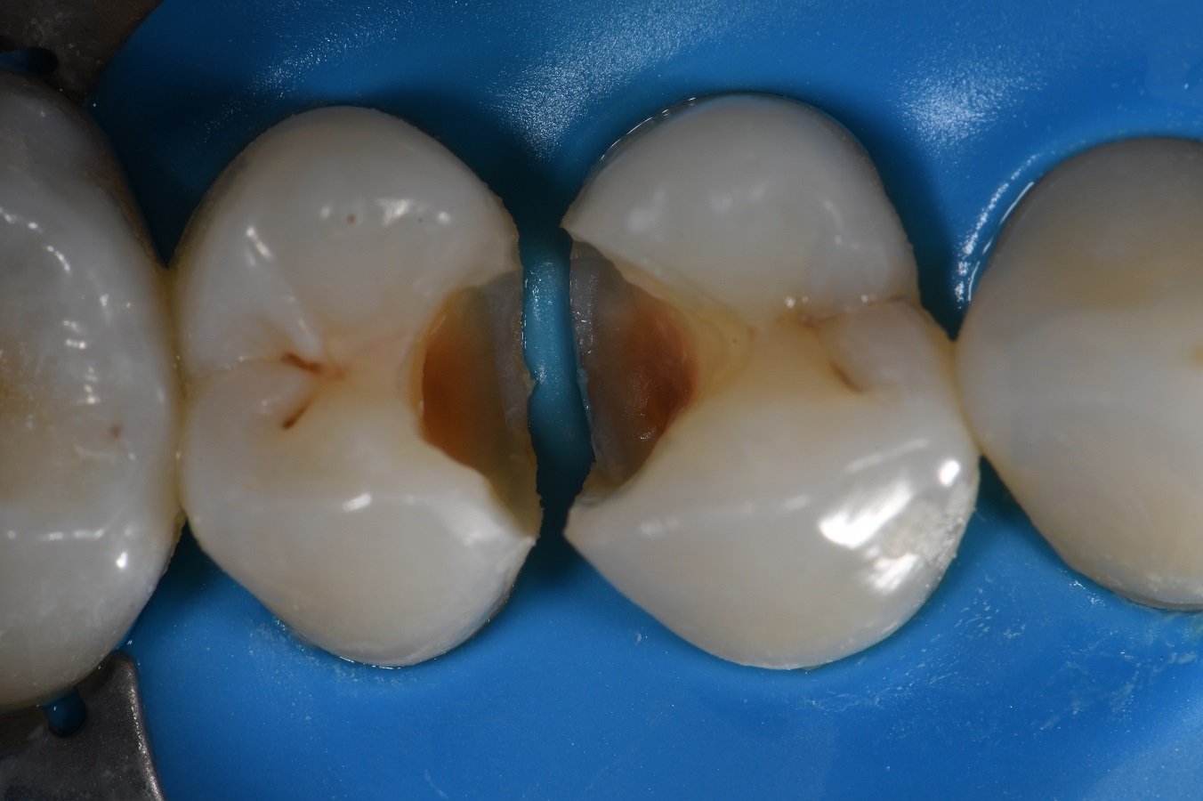 Matrix in Matrix strategy for Class II reconstructions