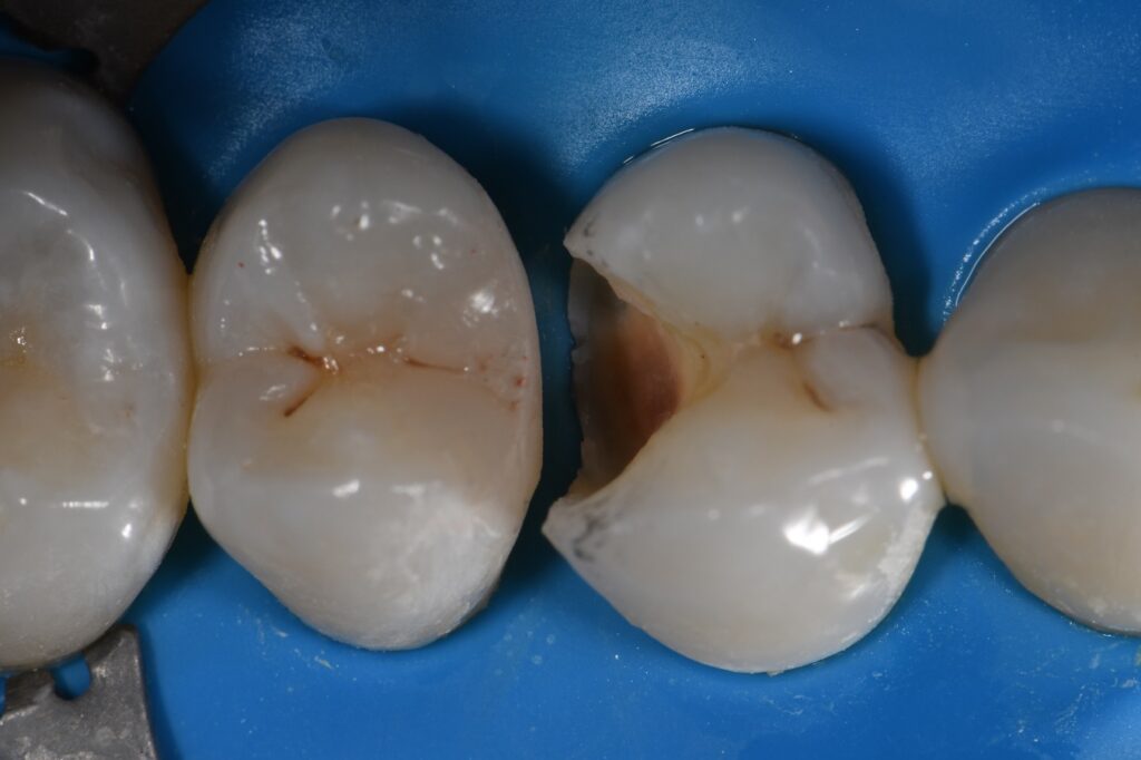 Matrix in Matrix strategy for Class II reconstructions