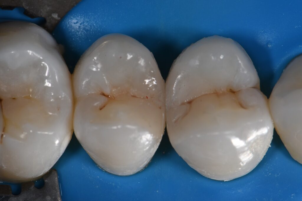 Matrix in Matrix strategy for Class II reconstructions