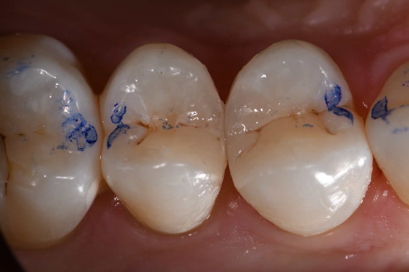 Matrix in Matrix strategy for Class II reconstructions