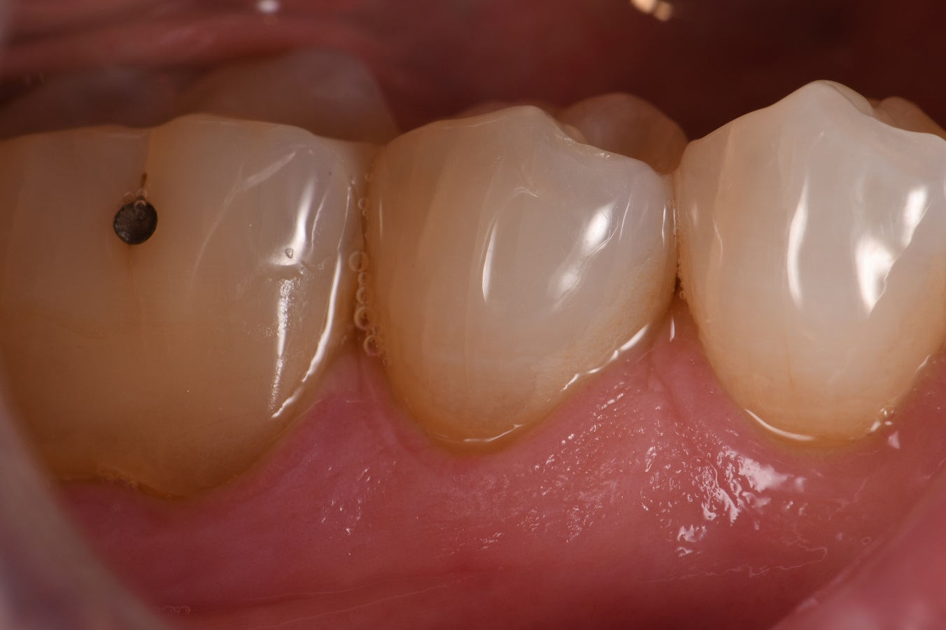 Cervical Abrasion Lesions Cervical Abrasion Lesions