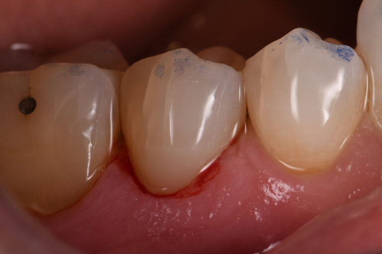 Cervical Abrasion Lesions Cervical Abrasion Lesions