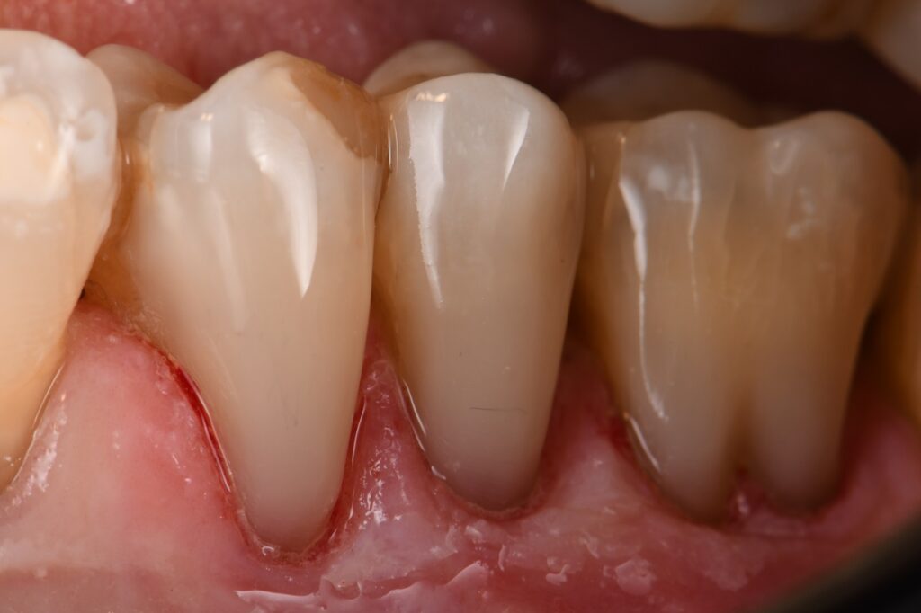 Scrubbing Teeth Too Hard can Result in Abrasion Lesions