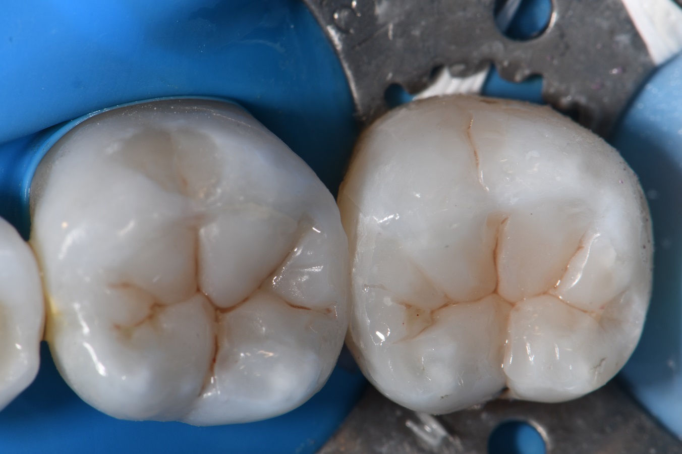 Simple Shade Selection Composite Resin | Kerr Simplishade