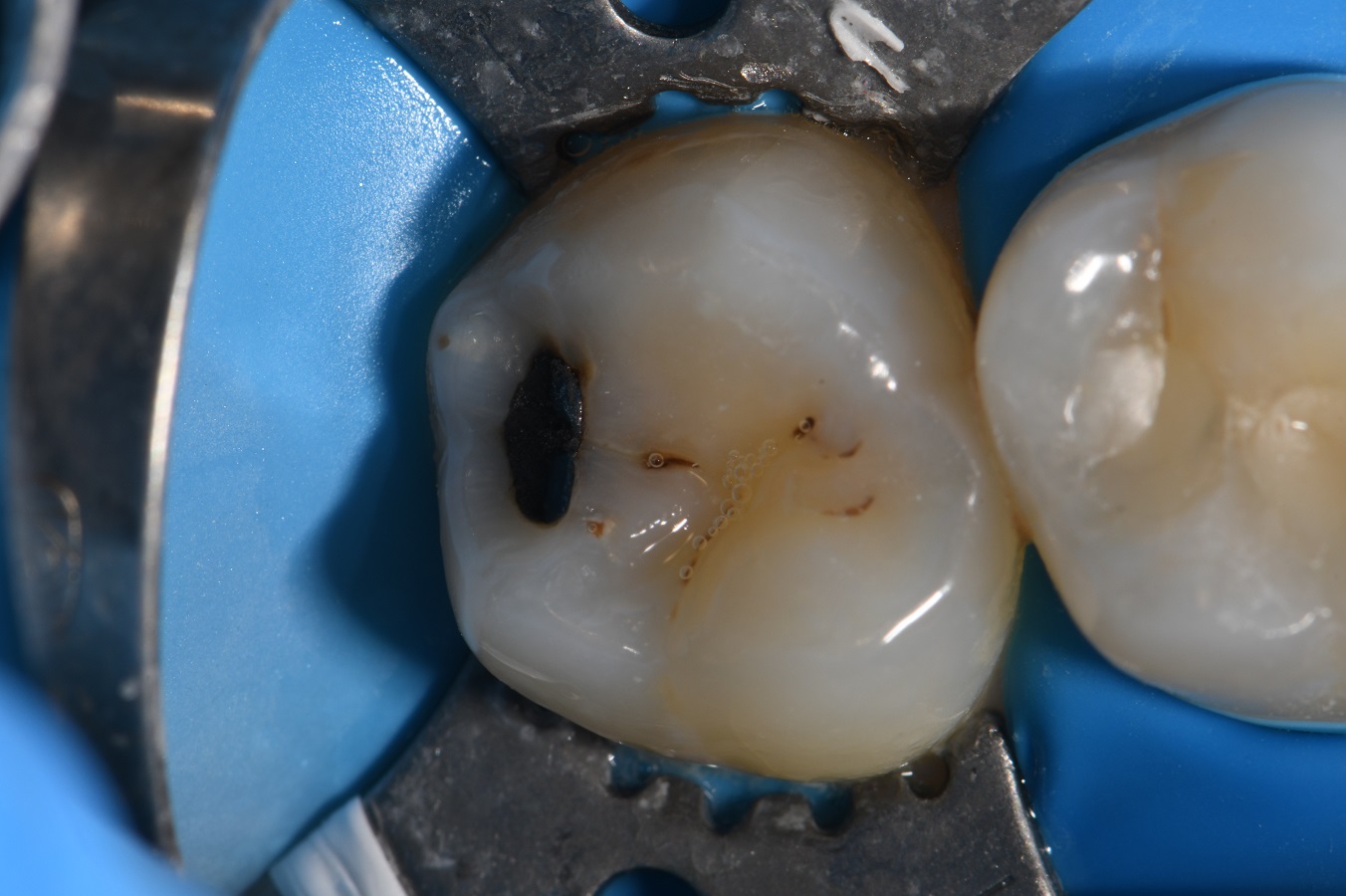 Removing Amalgams Invisibly Removing Amalgams Invisibly Removing Amalgams Invisibly Removing Amalgams Invisibly