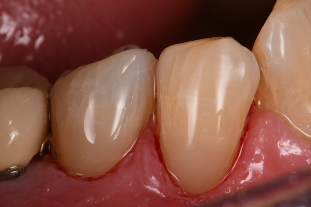 Toothbrush Aggressive Scrubbing Damage Reversed