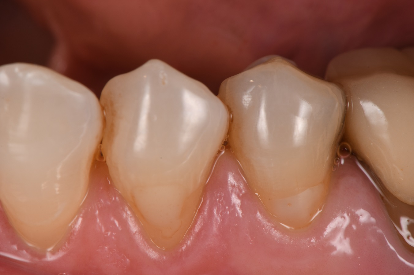 Horizontal Brush Technique Damage