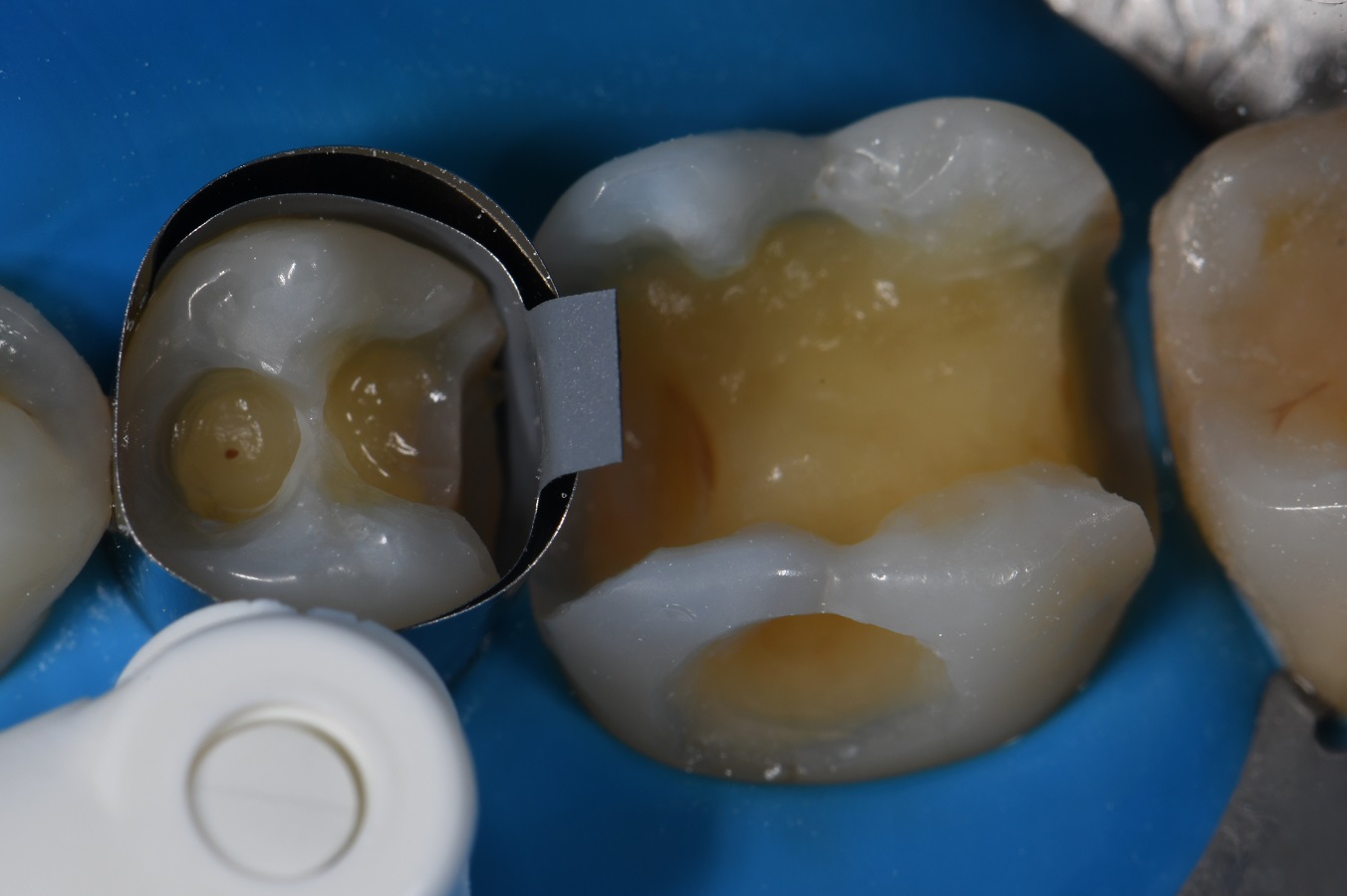 Matrix in Matrix Complex Composite Reconstruction
