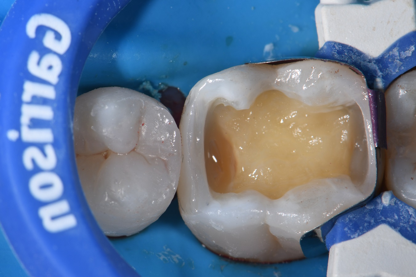 Matrix in Matrix Complex Composite Reconstruction