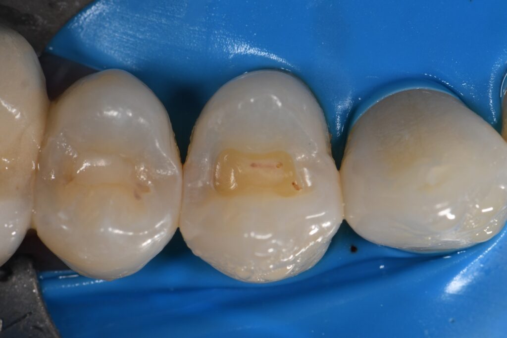 Simple Invisible Composite with Fissure Details