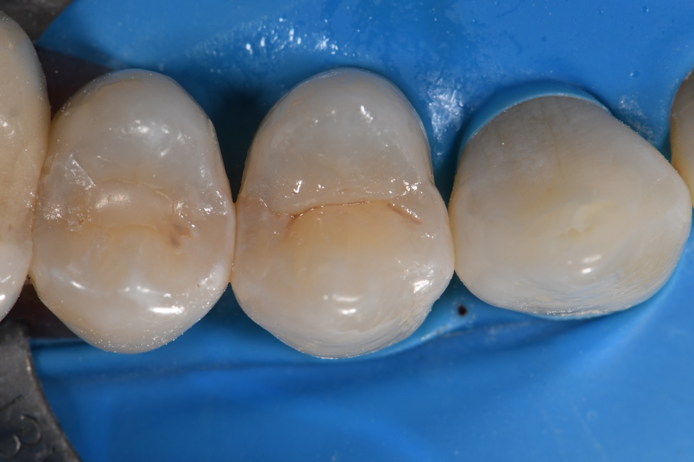 Simple Invisible Composite with Fissure Details