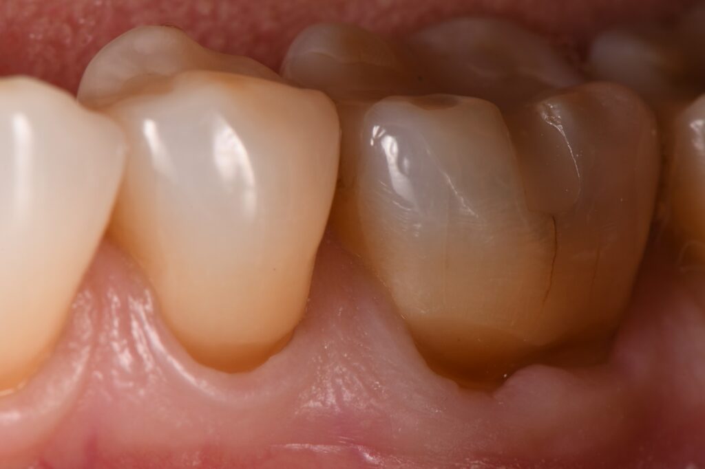 Insulating exposed dentin in cervical abrasion lesions