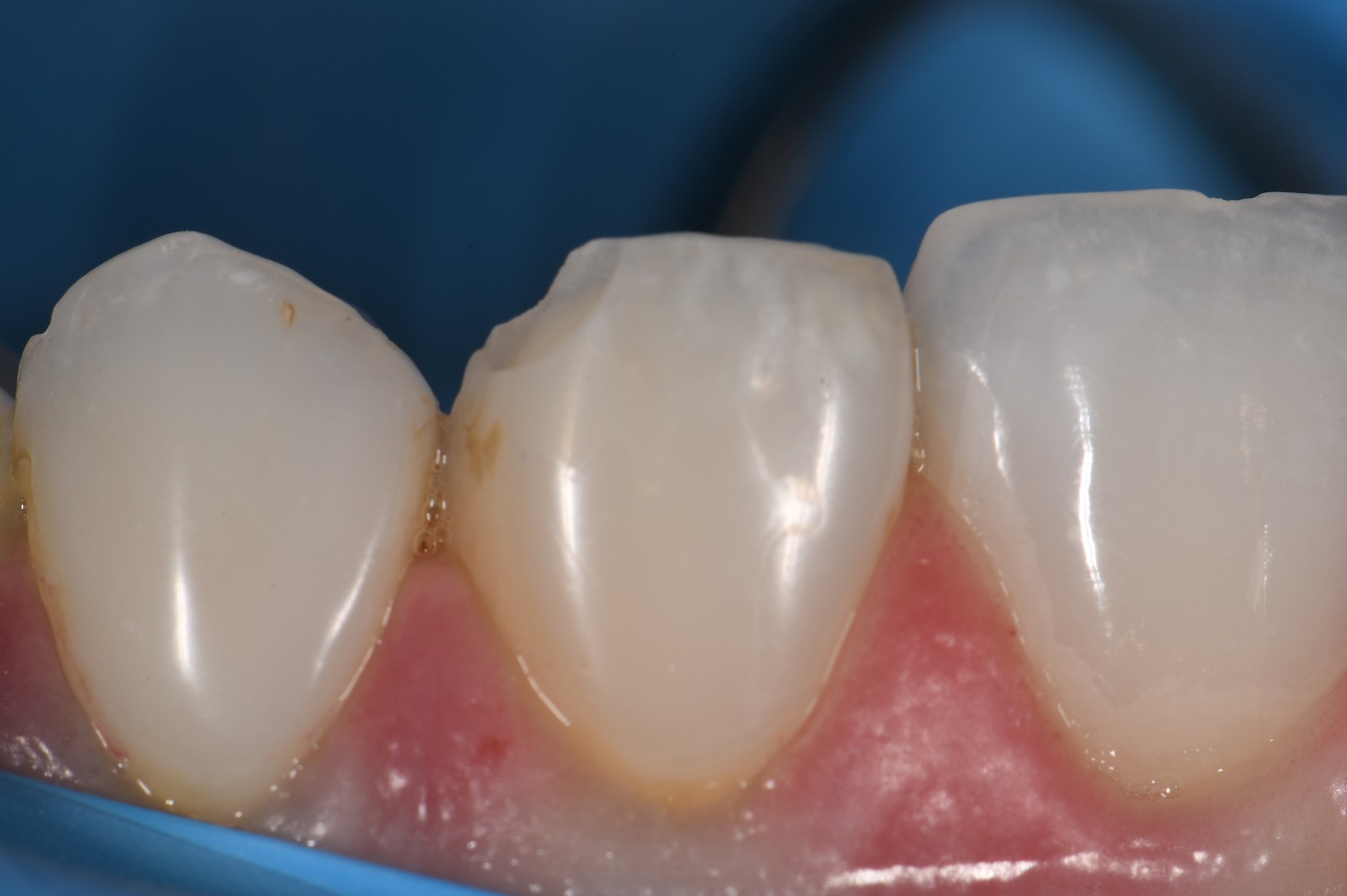 Composite Veneer Repair Step by Step Composite Veneer Repair Step by Step