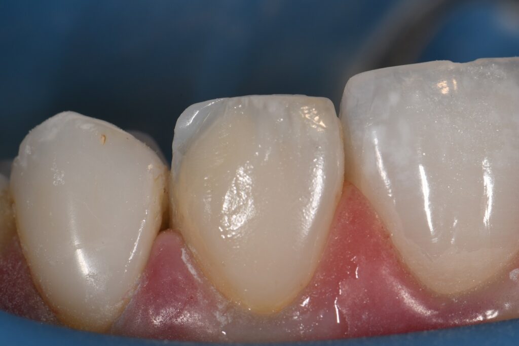 Composite Veneer Repair Step by Step Composite Veneer Repair Step by Step