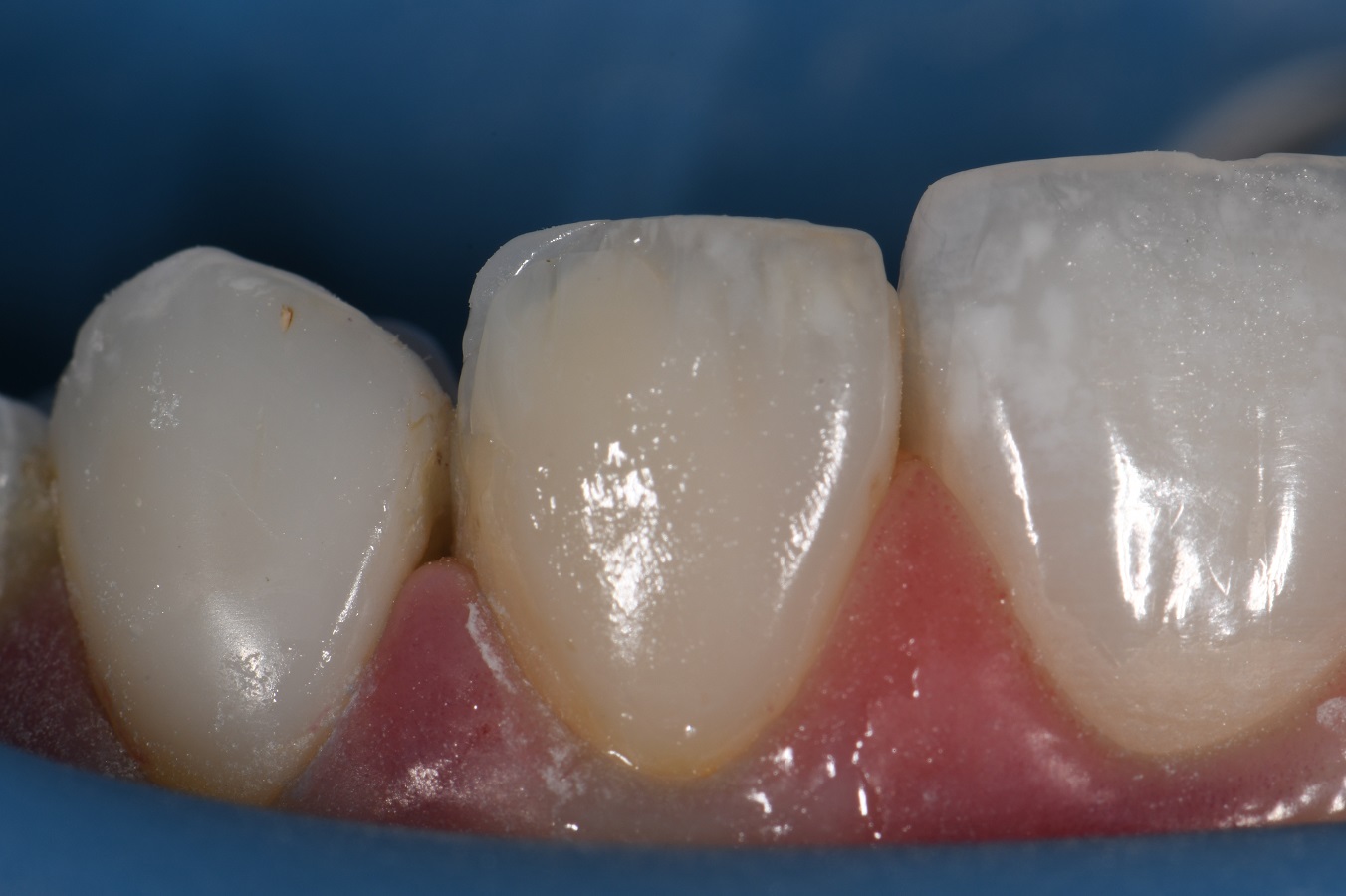 Composite Veneer Repair Step by Step Composite Veneer Repair Step by Step