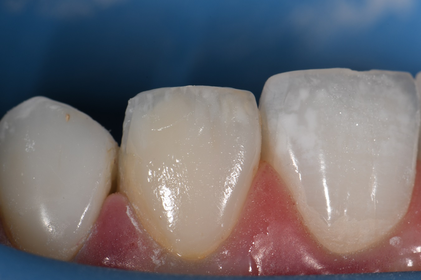 Composite Veneer Repair Step by Step Composite Veneer Repair Step by Step