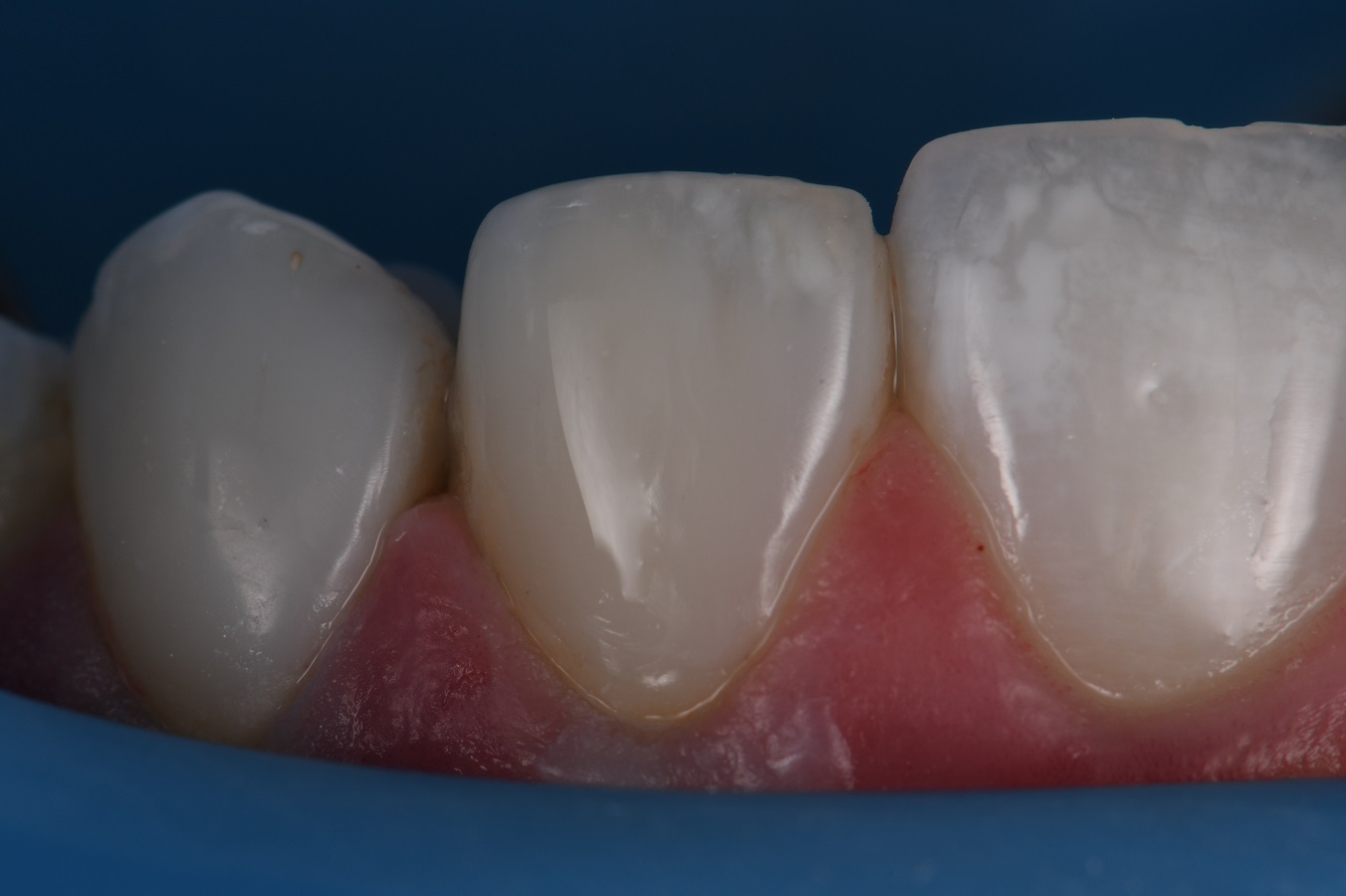 Composite Veneer Repair Step by Step Composite Veneer Repair Step by Step