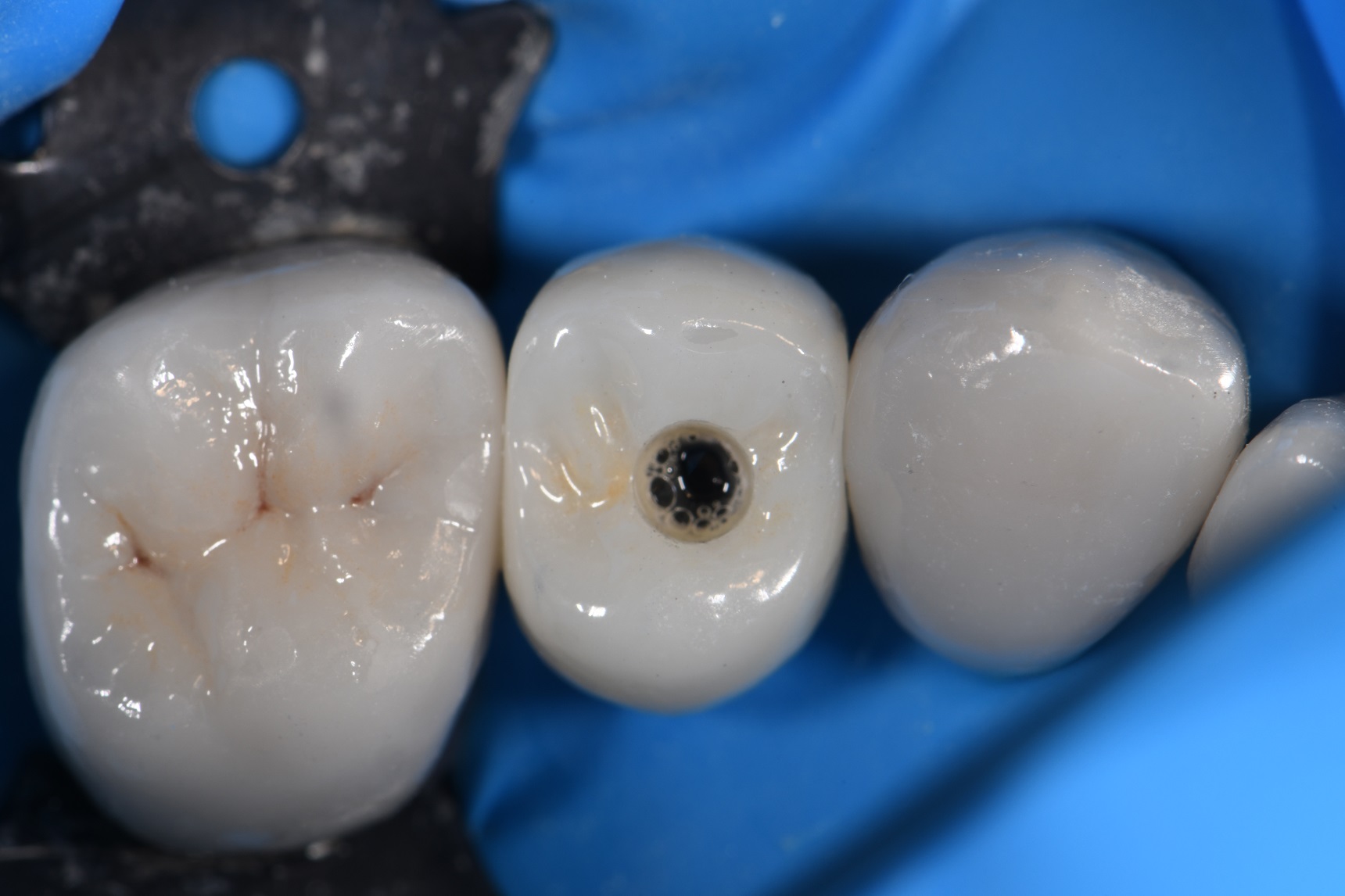 Implant Composite Closure for Screw Access