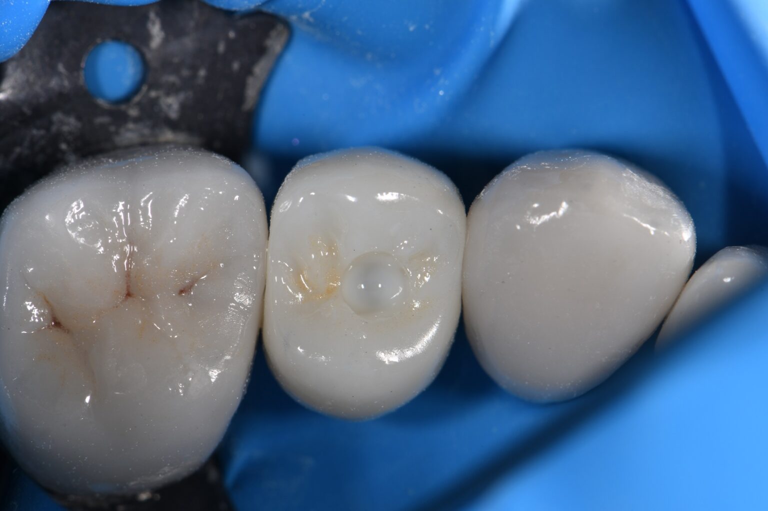 Implant Composite Closure for Screw Access