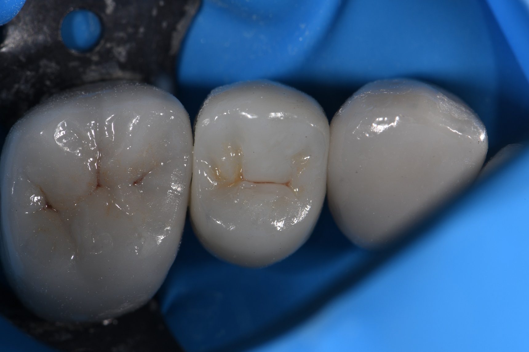 Implant Composite Closure for Screw Access