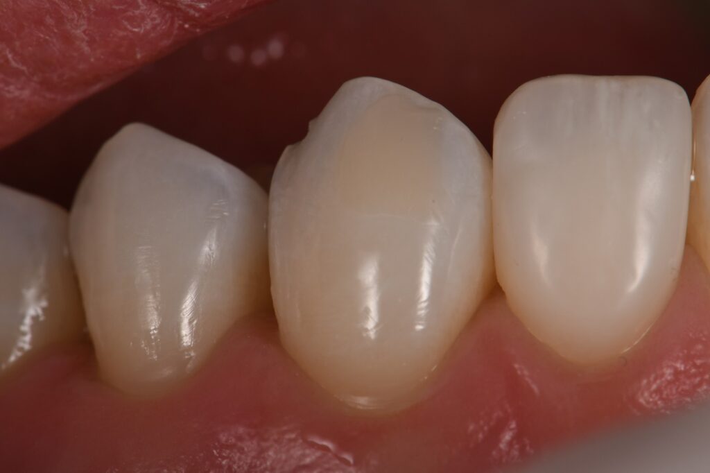 Subtleties in Adhesive Bonding Make all the Difference