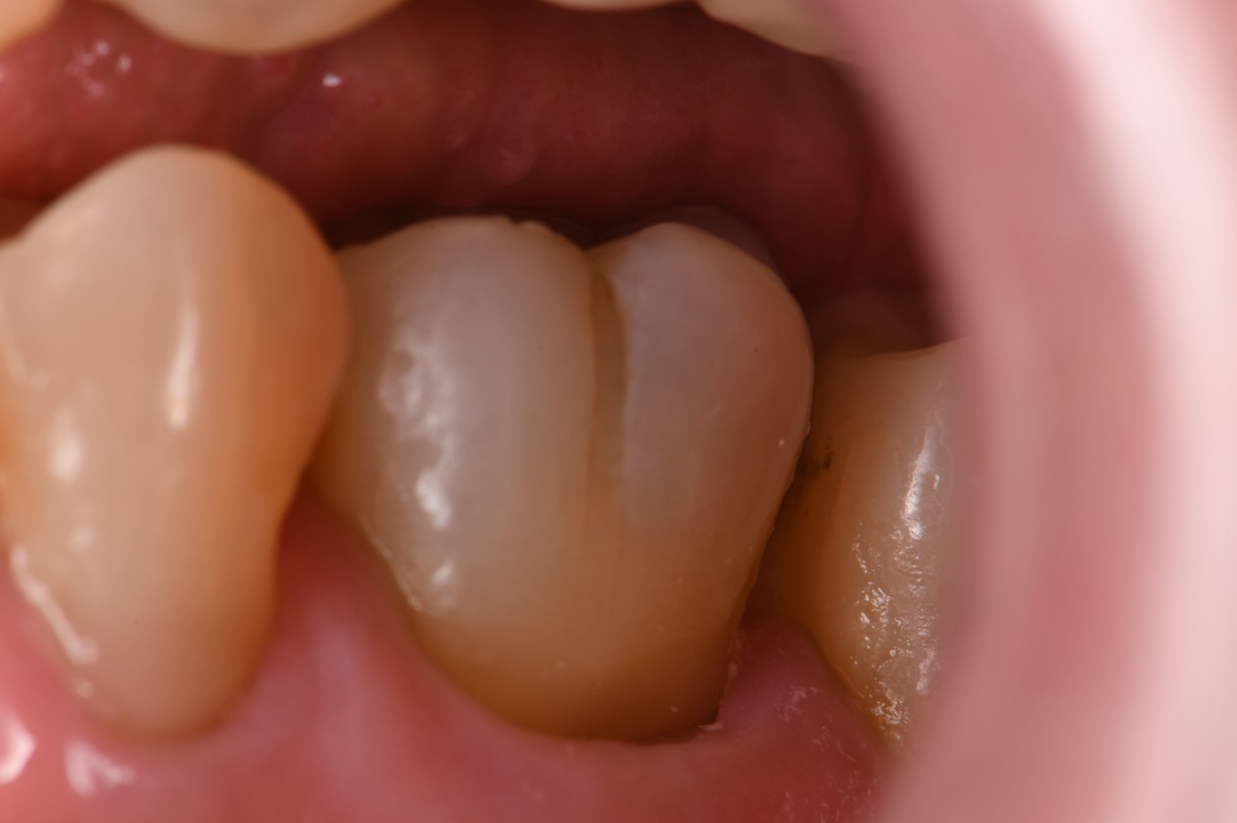 Subgingival clefts and food traps