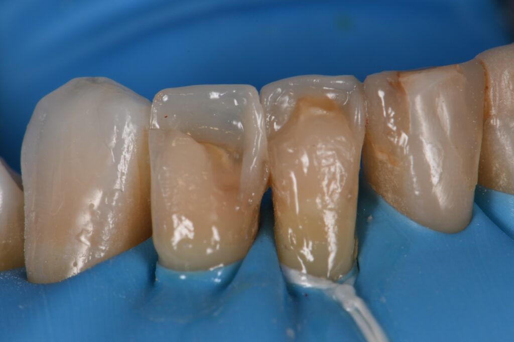Dental Expert to Freehand Composite Restorations