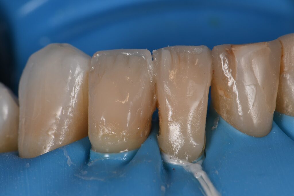 Dental Expert to Freehand Composite Restorations