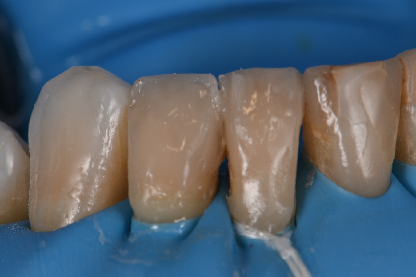Dental Expert to Freehand Composite Restorations