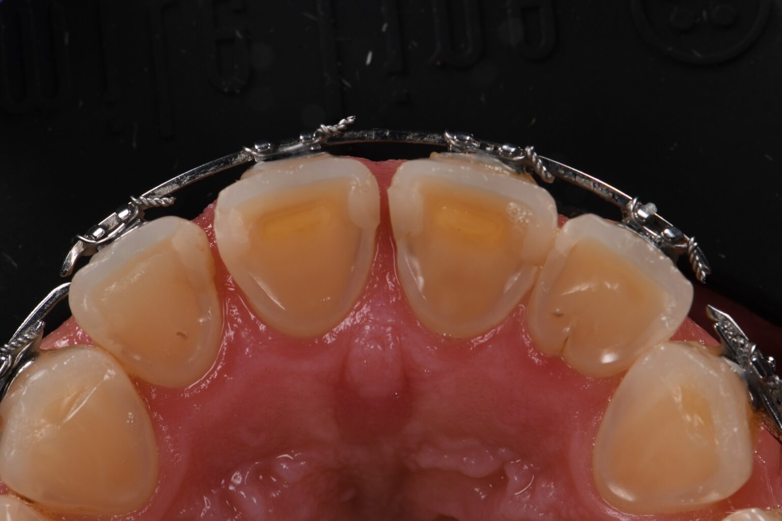 Building up Acid Eroded Tooth Structure Presurgically