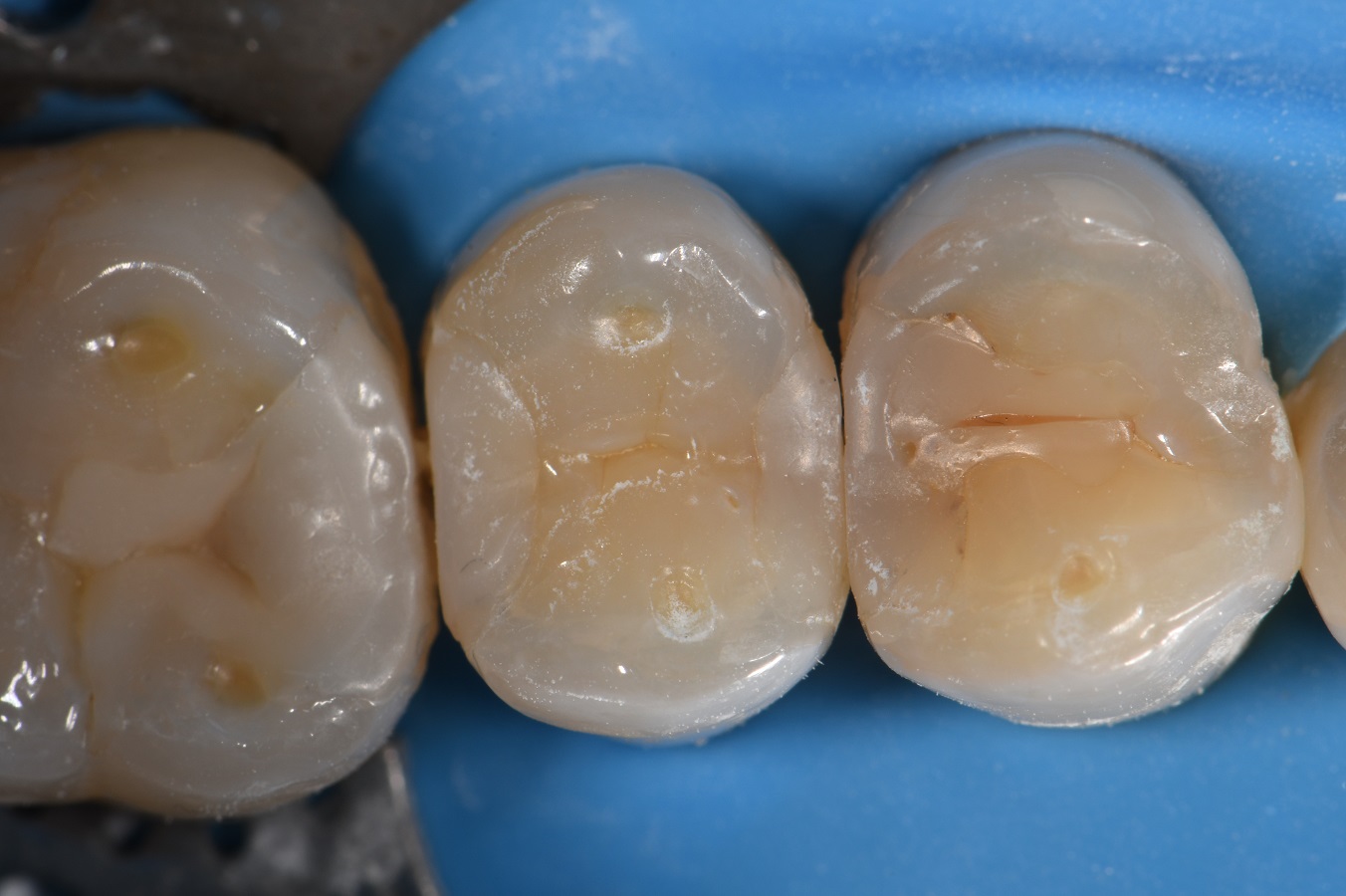 Deep complex cavities restored biomimetically
