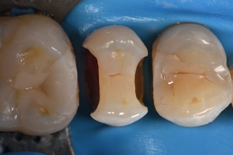 Deep complex cavities restored biomimetically