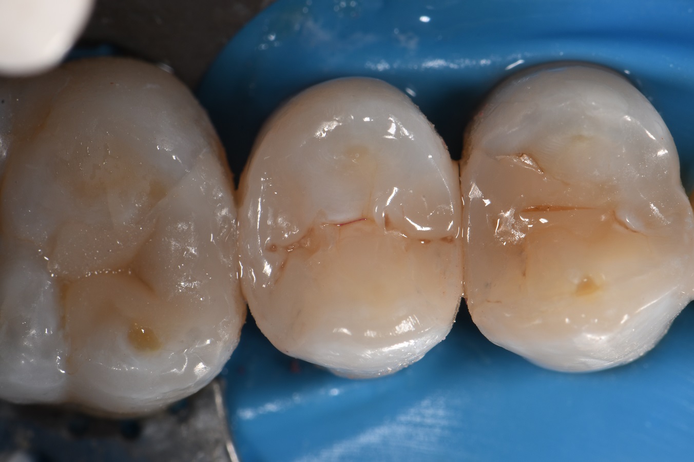 Deep complex cavities restored biomimetically