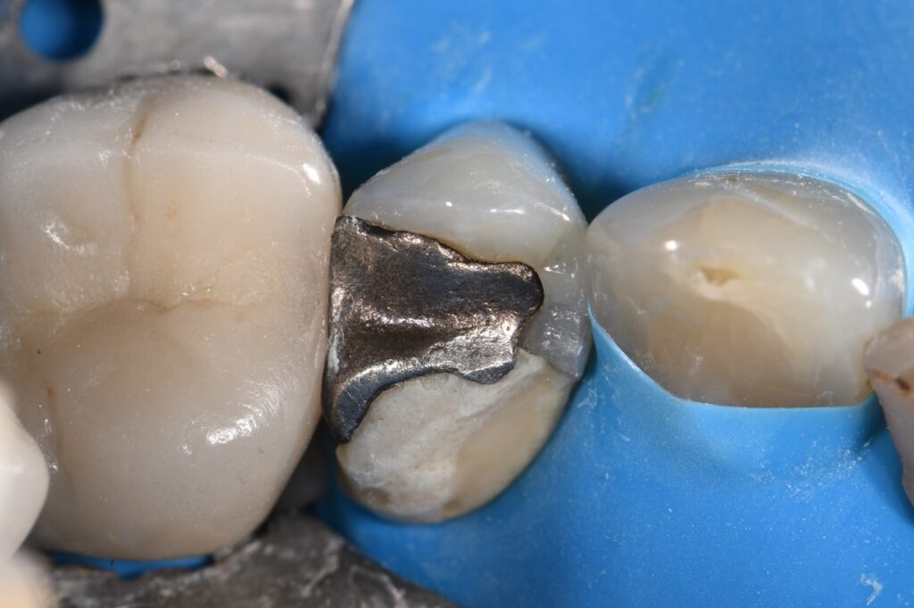 Ormocer base for a complex composite restoration