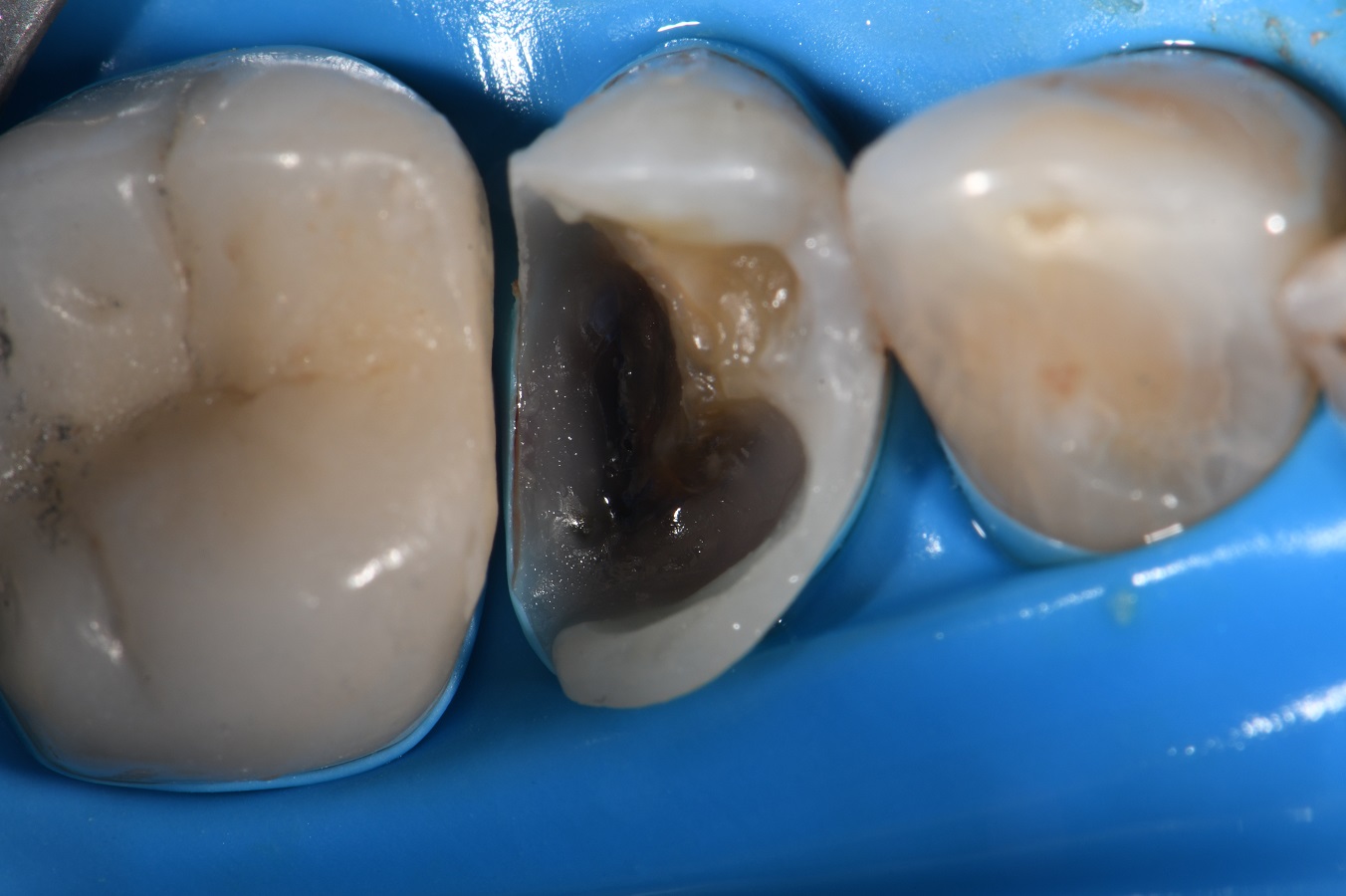 Ormocer base for a complex composite restoration